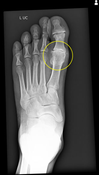 Foot Arthritis Conditions Sydney | Care First Orthopaedic